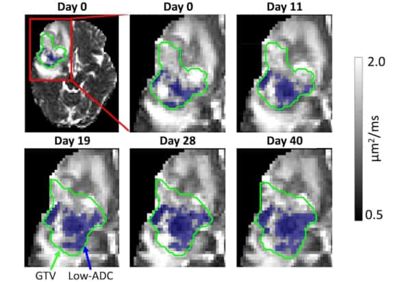 Imaging on an MR-Linac identifies radiation-resistant brain tumours ...