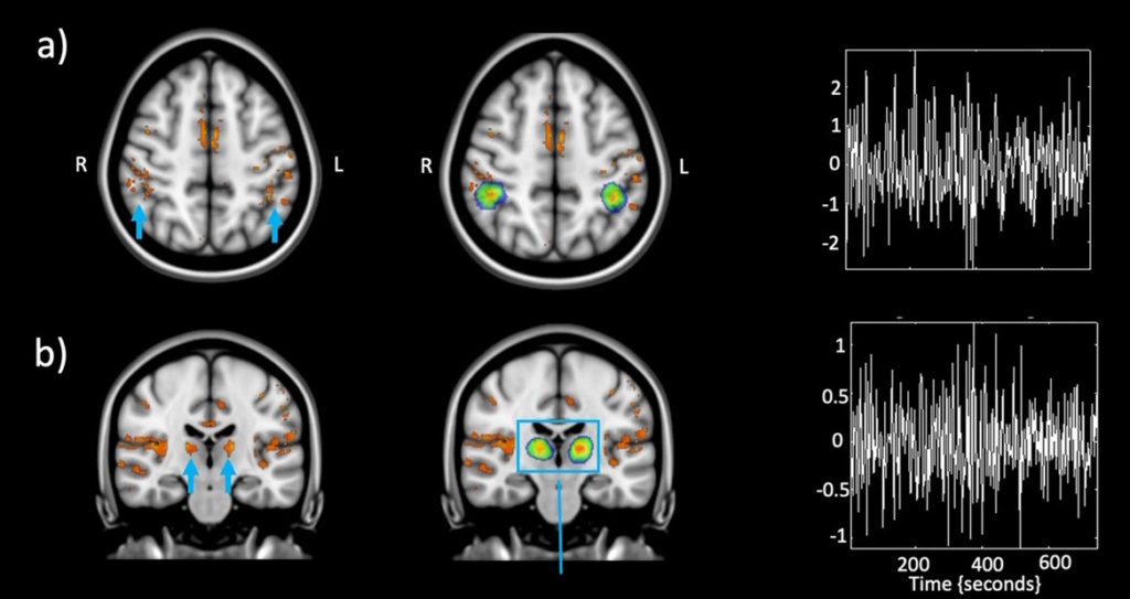 Ultrahigh-field MRI reveals how blue light stimulates the brain ... Ultrahigh-field MRI reveals how blue light stimulates the brain ...