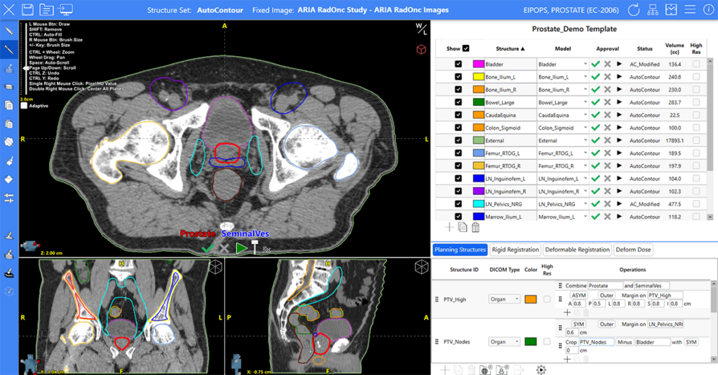 The Automation Era Enhancing Speed And Precision In Radiotherapy Physics World