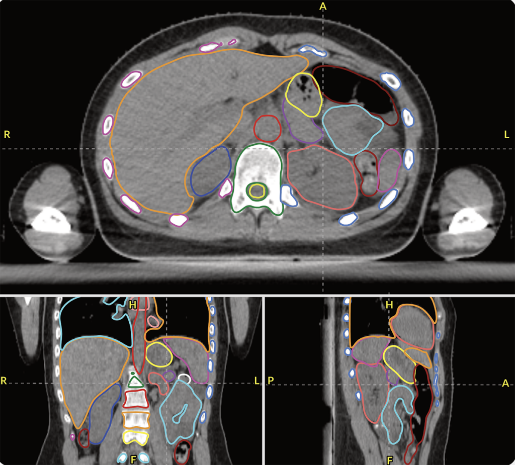 The automation era: enhancing speed and precision in radiotherapy ...
