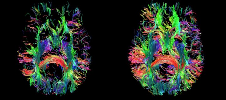 Next-generation 7 T scanner ramps the resolution of brain MR imaging ...