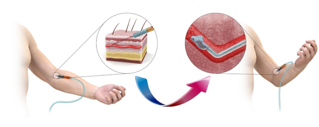 Smart intravenous needle softens upon insertion into a blood vessel ...