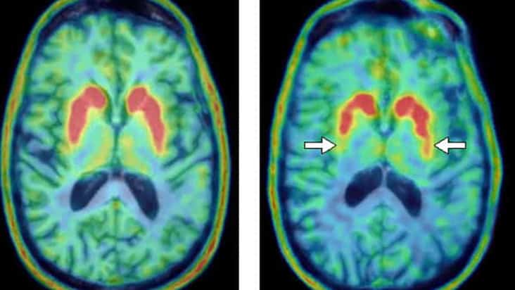 EXPLORER PET/CT produces first total-body scans – Physics World