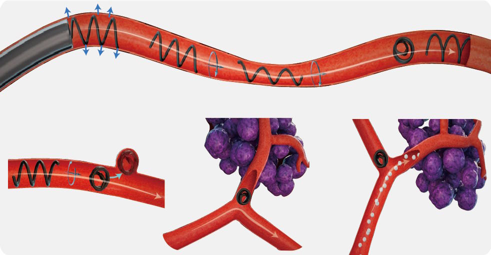 Magnetic microbots show promise for treating aneurysms and brain ...