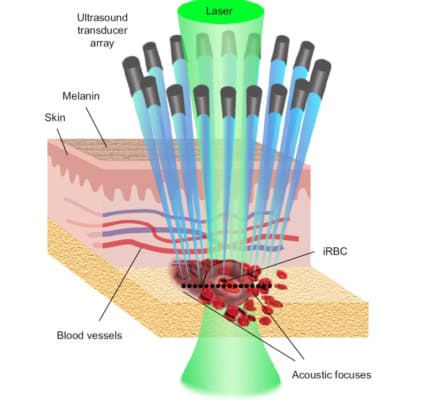 From melanoma to malaria: photoacoustic device detects disease without ...