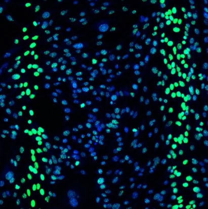 Microbeams plus radiosensitizers could optimize brain cancer treatment ...