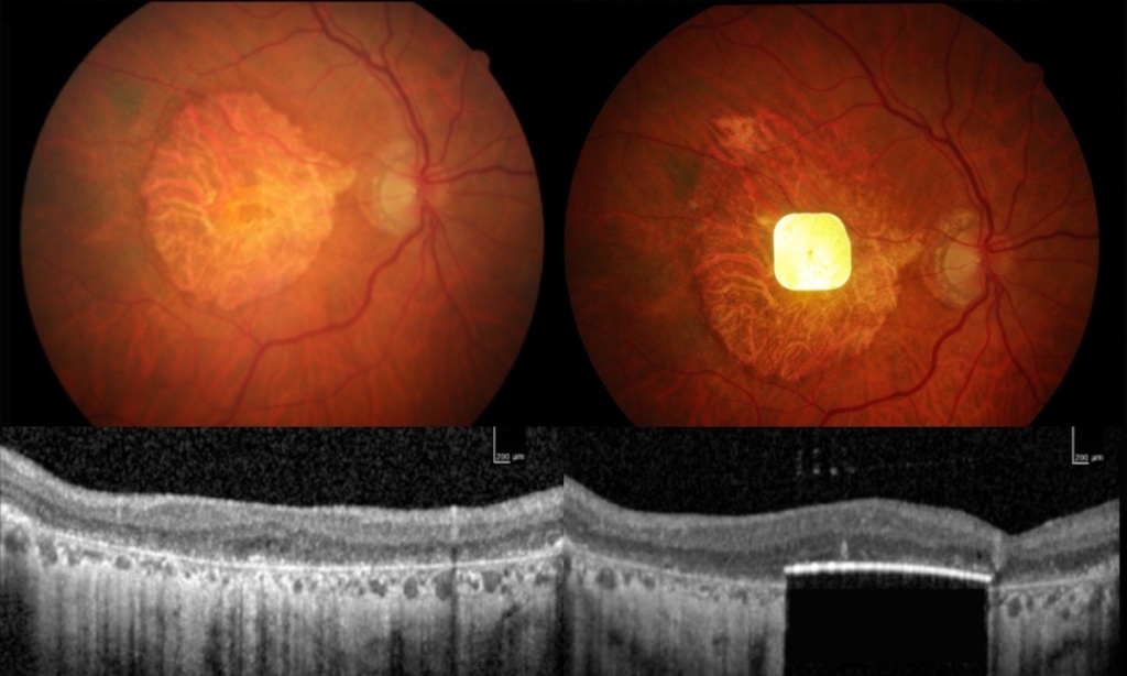 Eye implant restores vision to patients with incurable sight loss ...