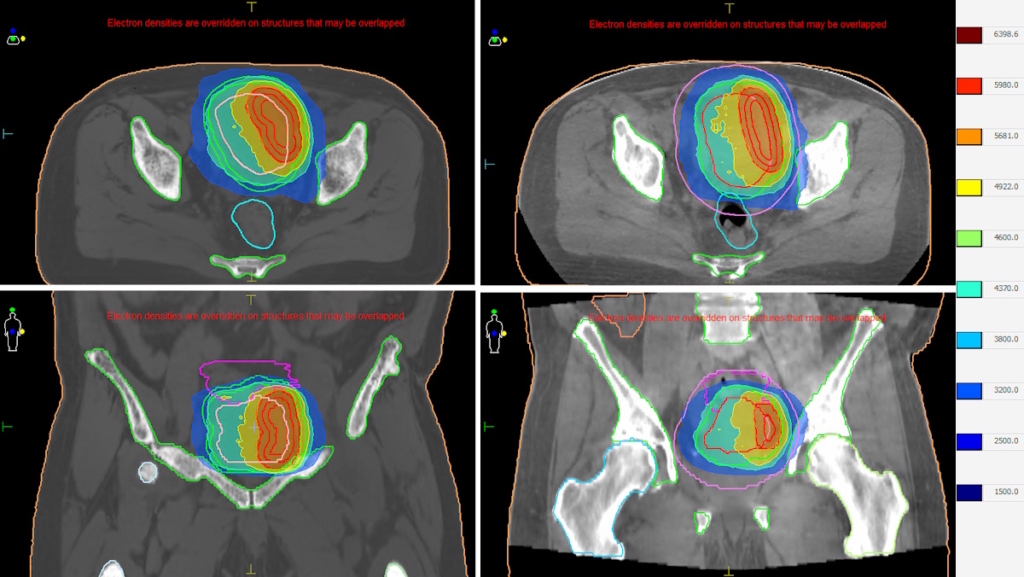 Fast and predictable: RayStation meets the needs of online adaptive ...