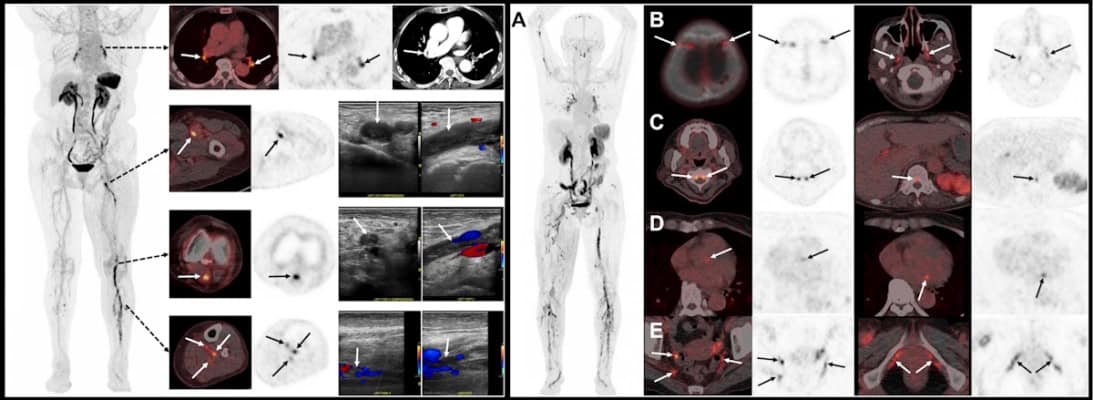 PET scan that detects dangerous blood clots is SNMMI ‘Image of the Year ...